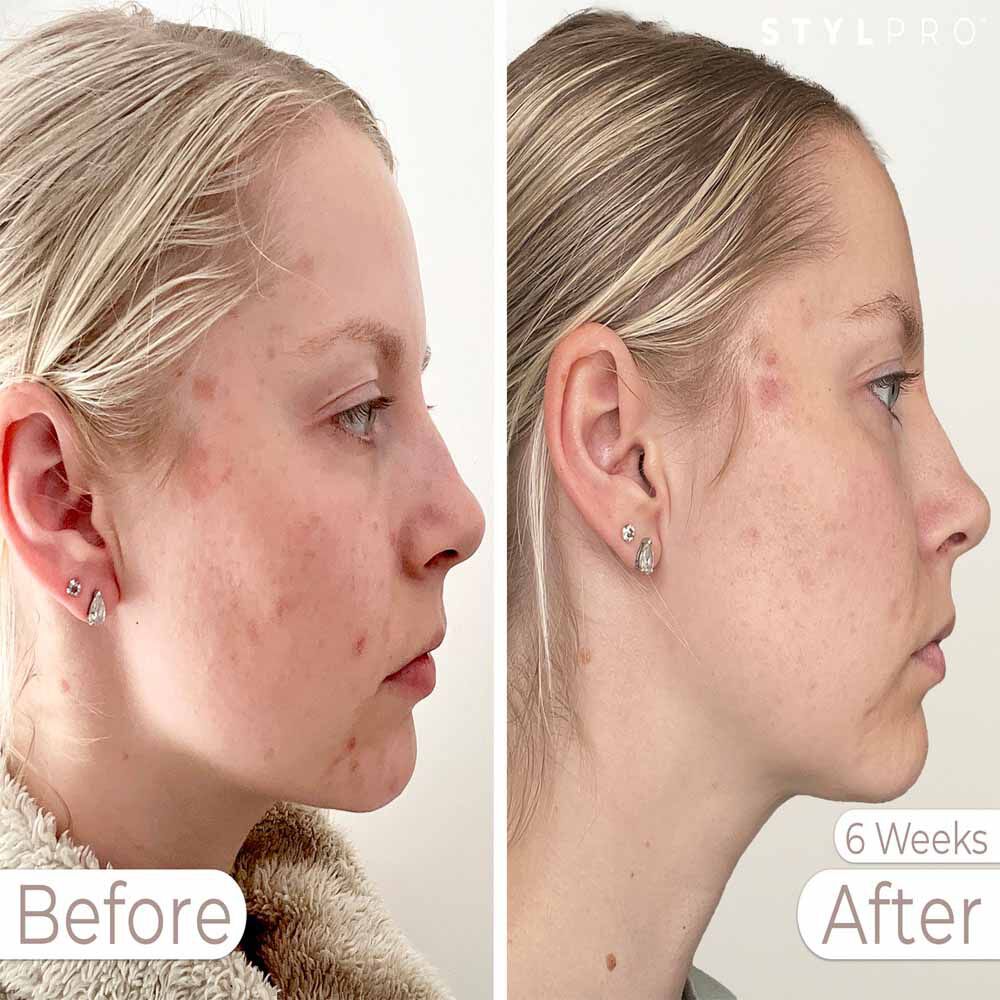 StylPro Wavelength LED Face Mask | Face Masks & Treatments | Sally Beauty