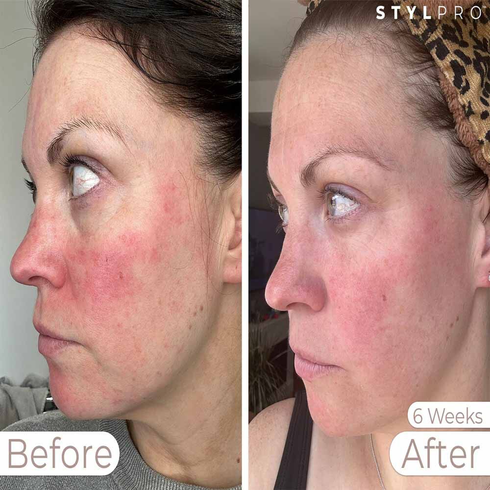 StylPro Wavelength LED Face Mask | Face Masks & Treatments | Sally Beauty